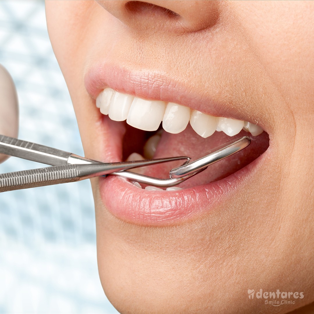 How to Get Your Teeth Done in Turkey | Dentares Dental Centre Turkey